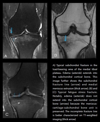 IO-Core Bone Marrow Injections - Nona Medical Arts