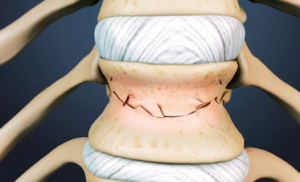 Kyphoplasty | Nona Medical Arts | Treat vertebral compression fractures