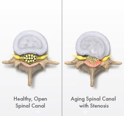 mild® procedure | Nona Medical Arts