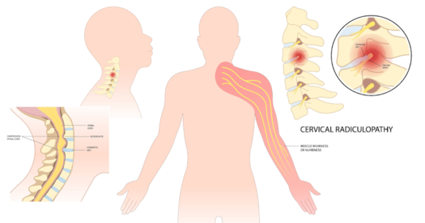 Treating Chronic Shoulder Pain Lake Nona Medical Arts
